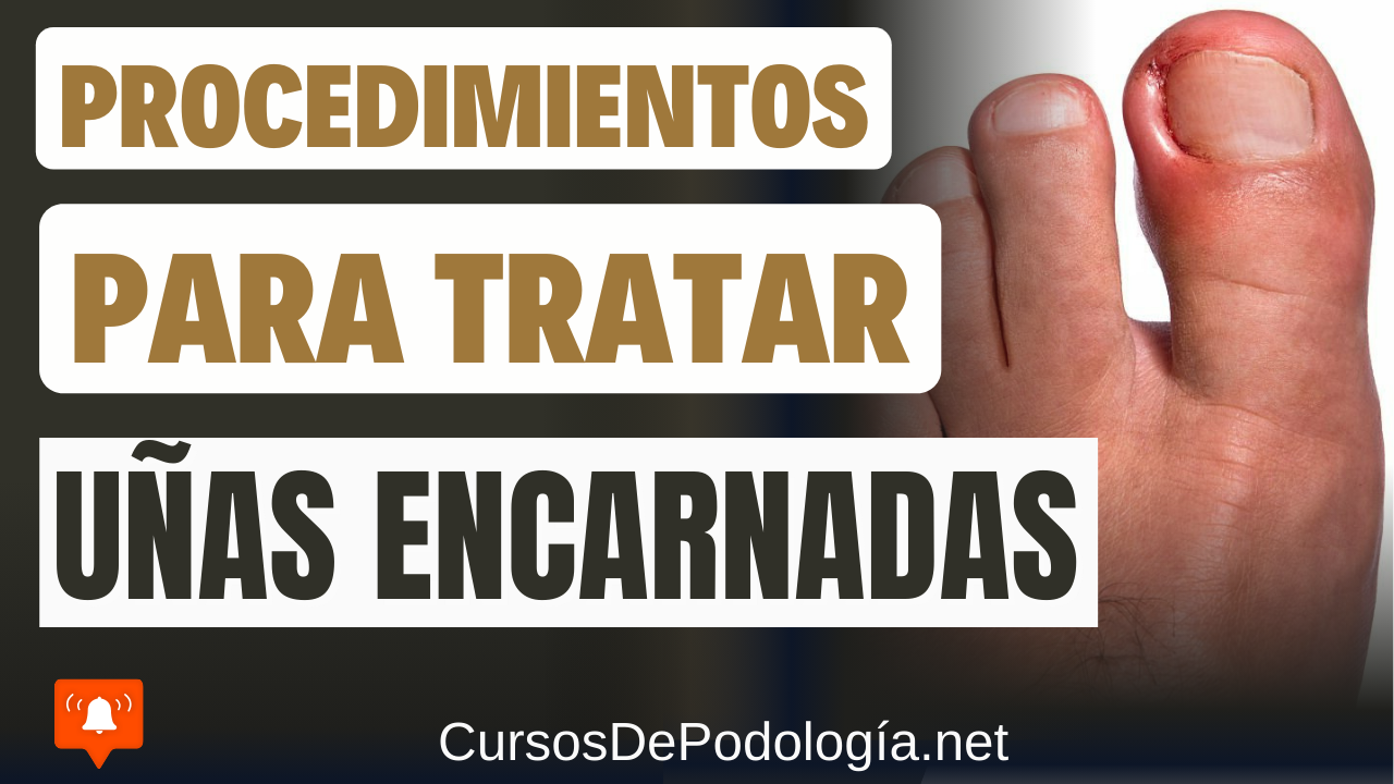 Procedimientos Para Tratar Uñas Encarnadas